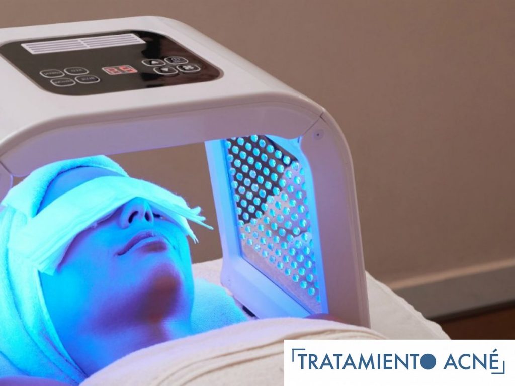 ¿Es un tratamiento facial bueno para el Acné? - Tratamientos para el acné